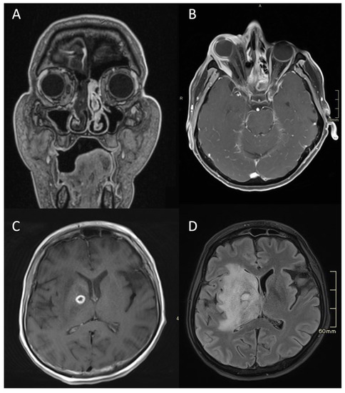 Atypical Skull-Base Osteomyelitis: Comprehensive Review and ...