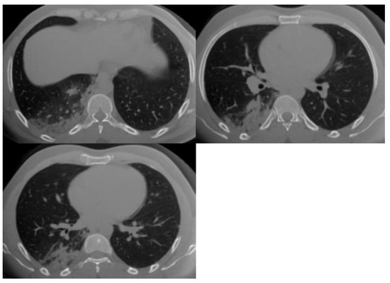 Inter-observer Variability in the Analysis of CO-RADS Classification ...