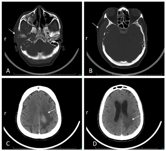 Central Nervous System Infection by Free-Living Nematode Cephalobus ...