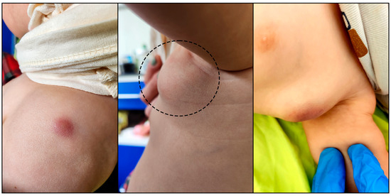 Unmasking Bacillus Calmette–Guérin Immune Reconstitution Inflammatory ...