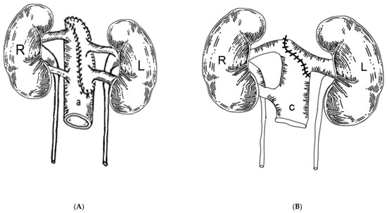 En-Bloc Transplantation of Dual Adult Kidneys with Multiple Vessels