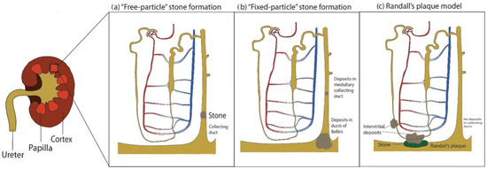 What Causes Calcium Oxalate Kidney Stones to Form? An Update on Recent ...