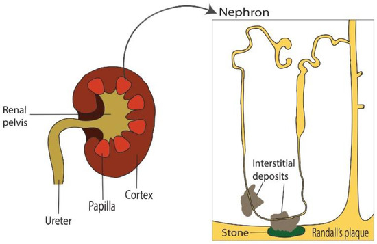 What Causes Calcium Oxalate Kidney Stones to Form? An Update on Recent ...