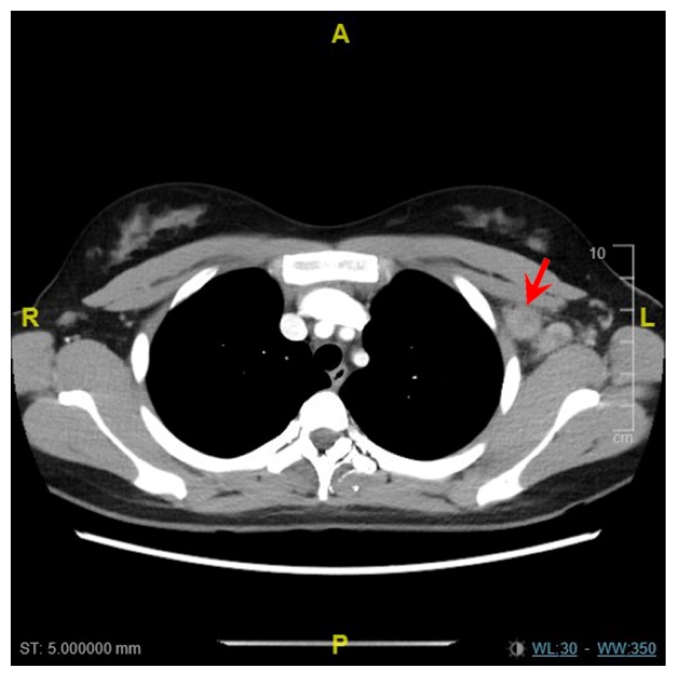 Infraclavicular Lymph Nodes Swollen