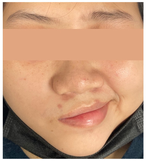 Polyneuritis Cranialis Associated with BNT162b2 mRNA COVID-19 Vaccine ...