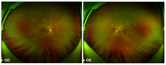 Probable Vogt–Koyanagi–Harada Disease after COVID-19 Vaccination: Case Report and Literature Review