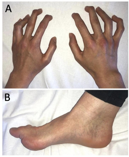 Neuromyotonia with Central Nervous System Lesions following ...