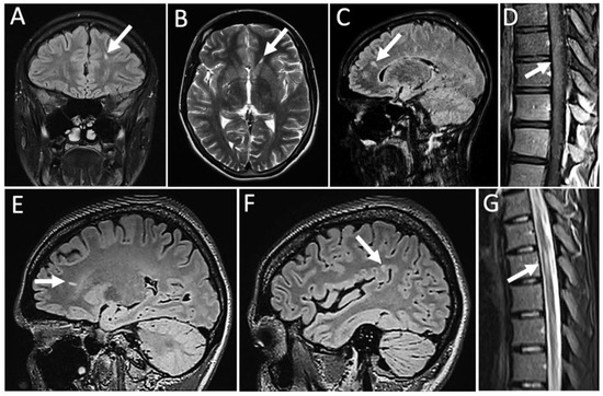 Neuromyotonia with Central Nervous System Lesions following ...