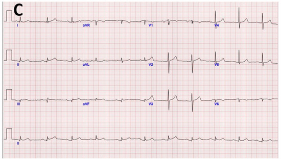 Acute Polyserositis with Cardiac Tamponade and Bilateral Refractory ...