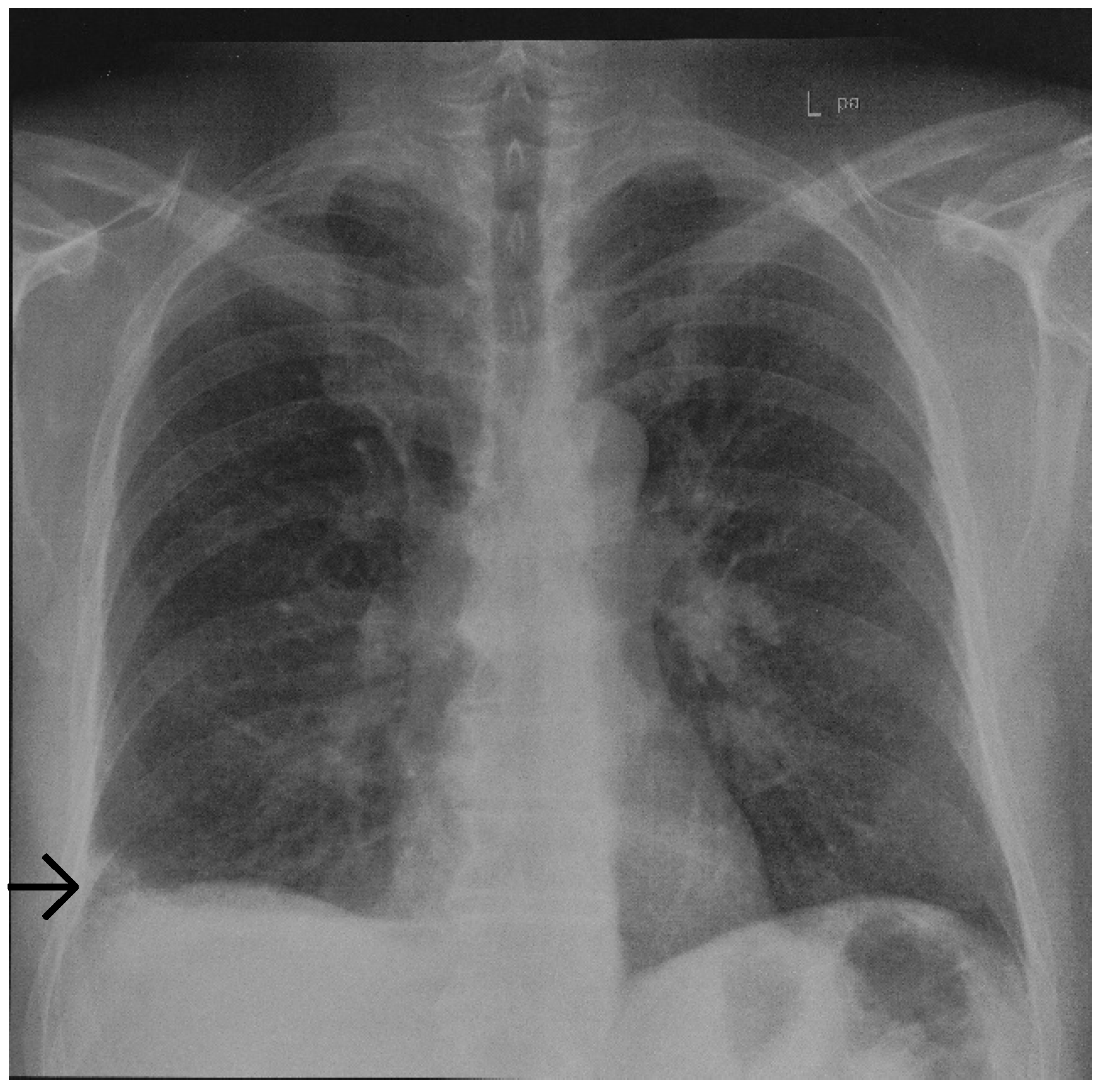 Temporal Association between Hampton’s Hump Pulmonary Embolism and ...