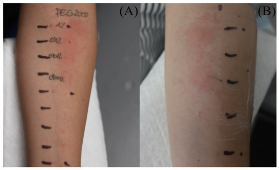 Study of Excipients in Delayed Skin Reactions to mRNA Vaccines ...