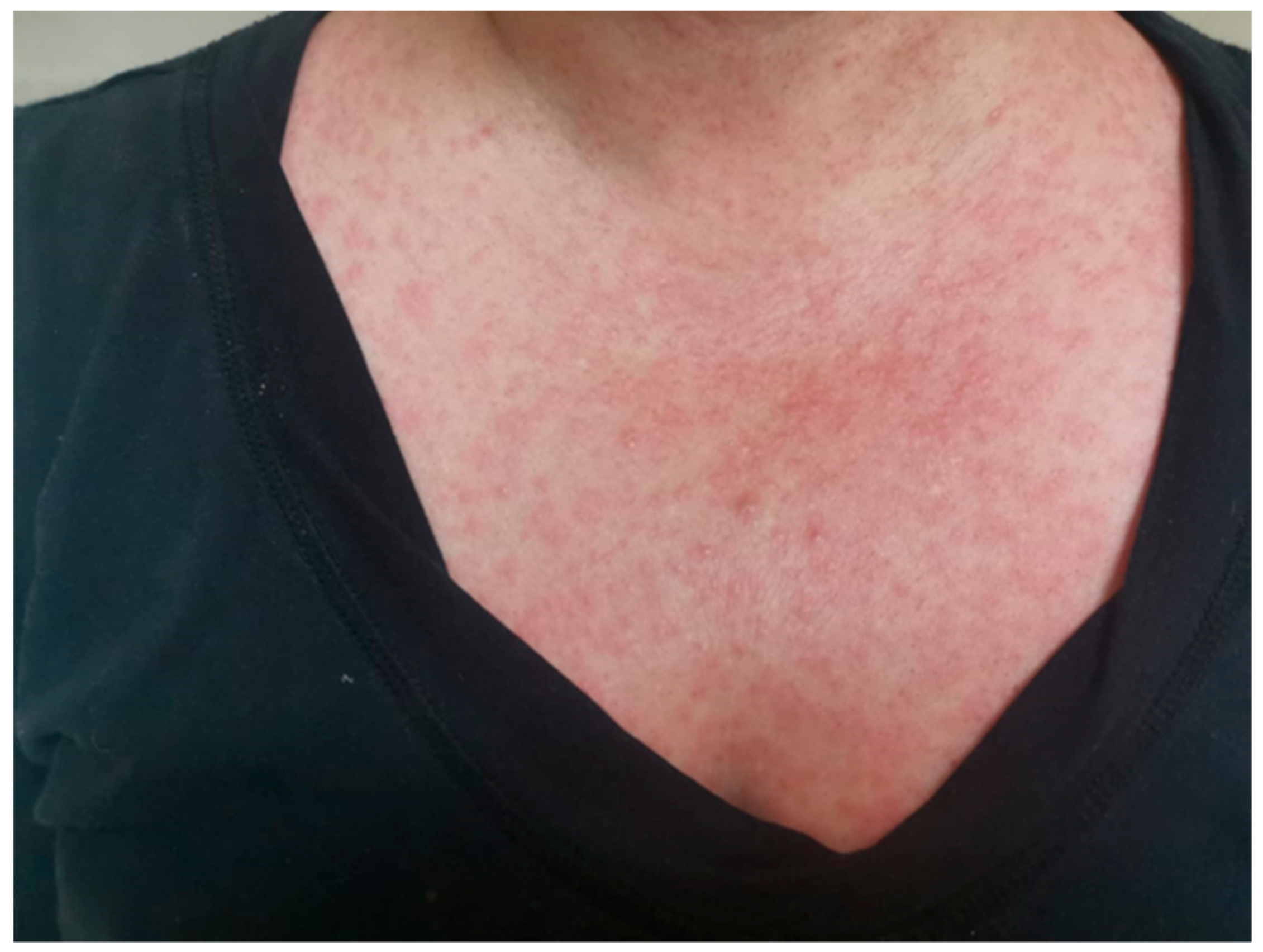 Vaccine-Associated Rubella Caused by the RA 27/3 Strain