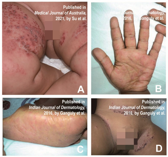 Hand Foot And Mouth Disease In Adults