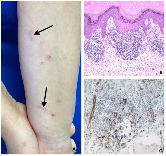 COVID-19 Vaccine-Induced Lichenoid Eruptions—Clinical and ...