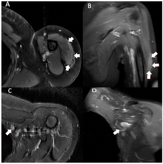 Shoulder Pseudo-Tumor from COVID-19 Vaccine