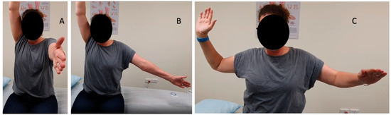 Shoulder Injury Related to Vaccine Administration (SIRVA) Is Real: A ...