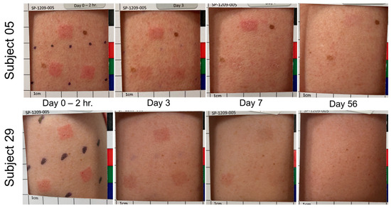 Safety, Tolerability, and Immunogenicity of Measles and Rubella Vaccine ...