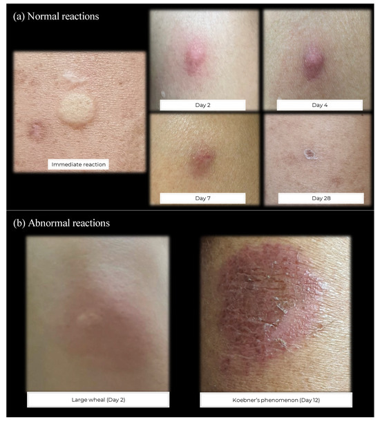 Immunogenicity of Intradermal Versus Intramuscular BNT162b2 COVID-19 ...