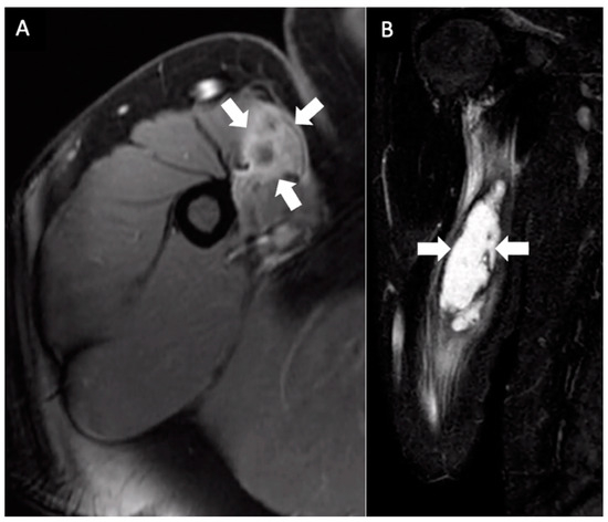 Right Biceps Pseudo-Tumor from COVID-19 Vaccination