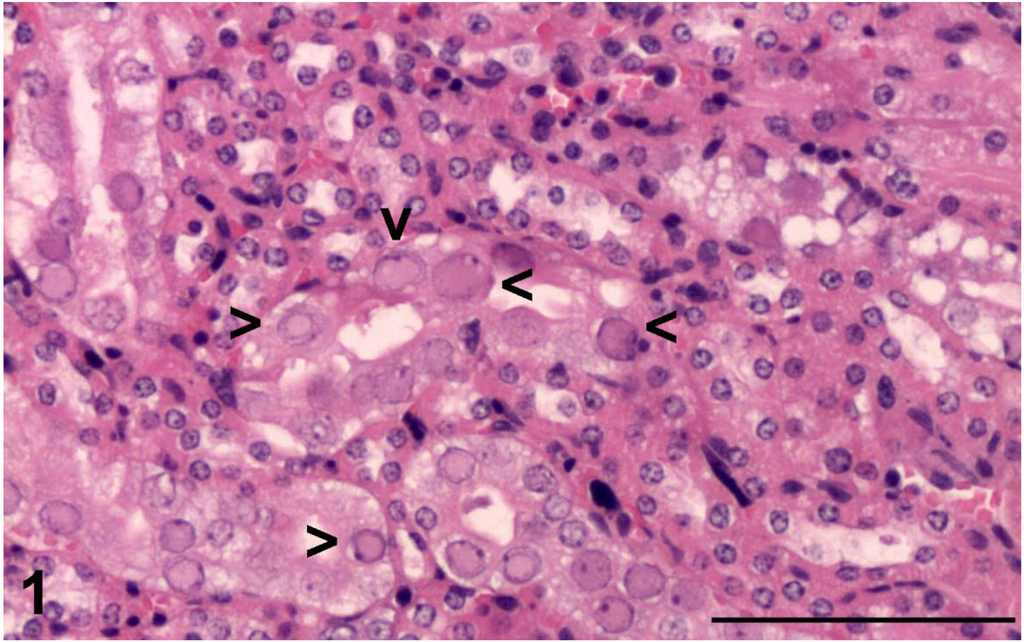 Intranuclear Inclusions in Renal Tubular Epithelium in Immunodeficient ...