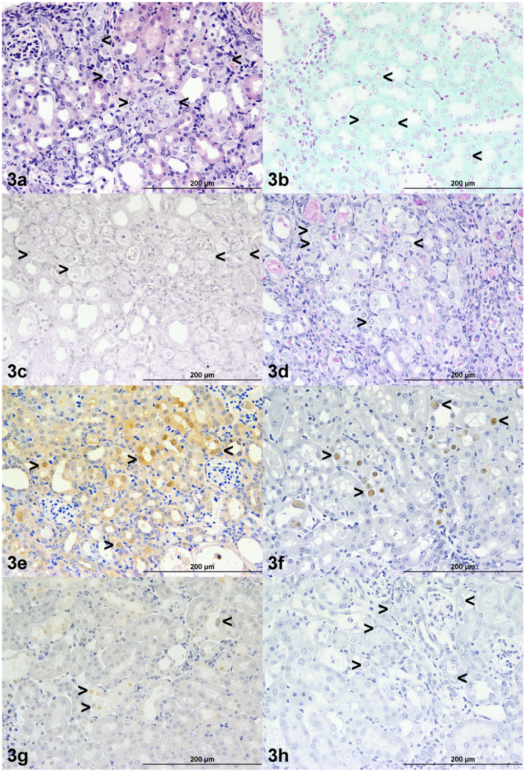 Intranuclear Inclusions in Renal Tubular Epithelium in Immunodeficient ...