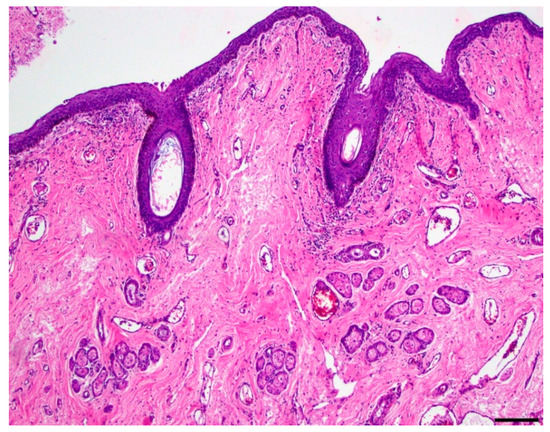 Incomplete Urethral Duplication Associated with a Dermoid Cyst within a ...