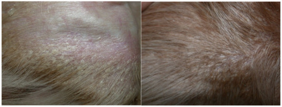 A Case of Sebaceous Adenitis and Concurrent Meibomian Gland Dysfunction ...