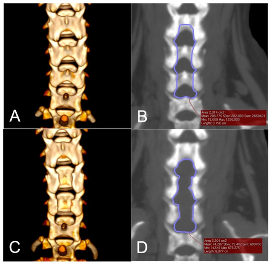 Microendoscopic Dorsal Laminectomy for Multi-Level Cervical ...