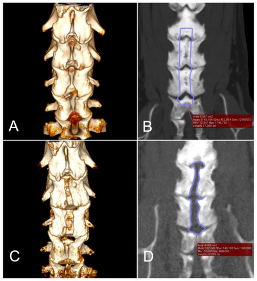 Microendoscopic Dorsal Laminectomy for Multi-Level Cervical ...