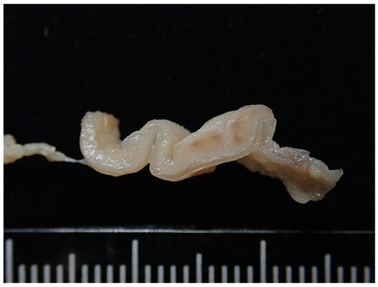 Mucus Strings In Stool