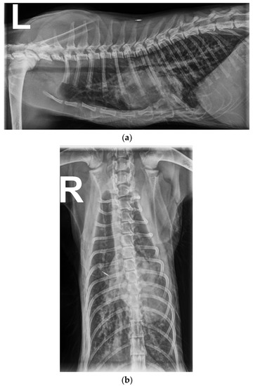 A Case of Congenital Pulmonary Vein Stenosis with Secondary Post ...