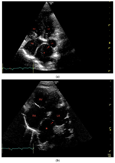 A Case of Congenital Pulmonary Vein Stenosis with Secondary Post ...