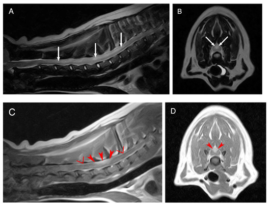 Metastatic Multifocal Malignant Peripheral Nerve Sheath Tumour in the ...