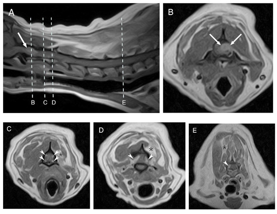 Metastatic Multifocal Malignant Peripheral Nerve Sheath Tumour in the ...