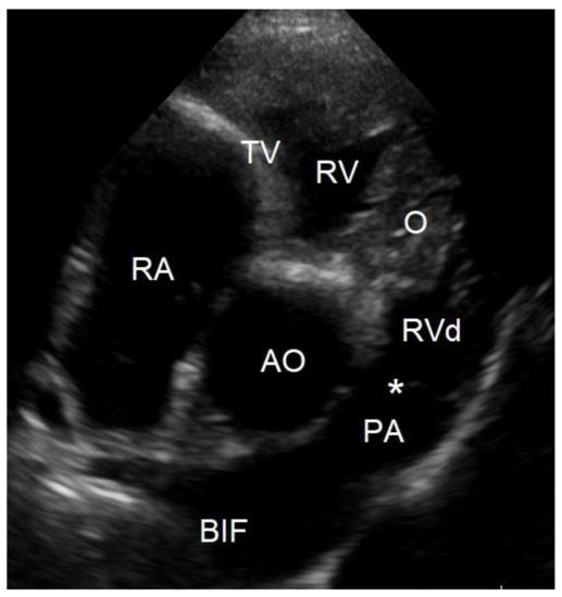 Progressive Right Ventricular Obstruction Caused by a Double-Chambered ...