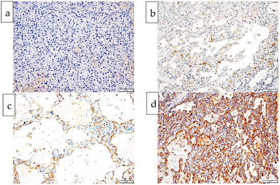 Histopathological Grading, Clinical Staging and CD 31 Expression of ...