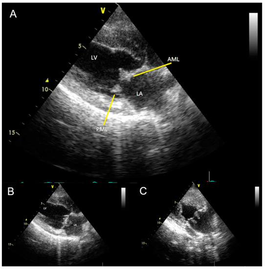 Limiting Factors in Treatment Success of Biofilm-Forming Streptococci ...