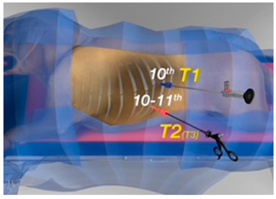 Thoracoscopic Assisted PleuralPortTM Application in Seven Dogs Affected ...