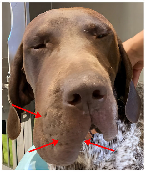 A Case Report of Presumptive Primary Lymphedema Localized to the Face ...