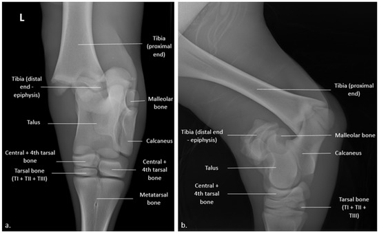 Surgical Management of a Salter-Harris Type I Distal Physeal Fracture ...