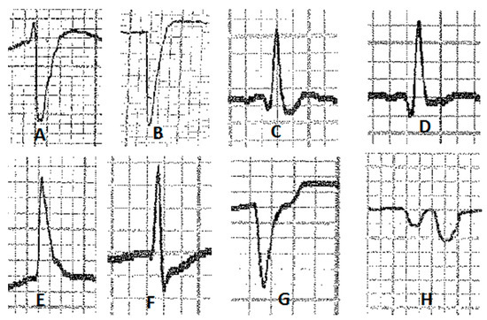 Electrocardiographic Reference Values in Clinically Healthy Lusitano Horses