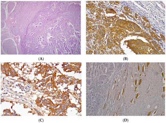 Extracutaneous Melanotic Melanoma with Nervous System Involvement in a ...