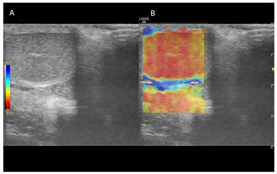 Ultrasound-Based Technologies for the Evaluation of Testicles in the ...