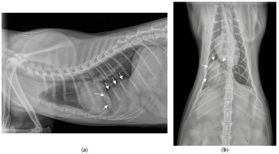 True Diaphragmatic Hernia (Morgagni Hernia) Incidentally Diagnosed with ...