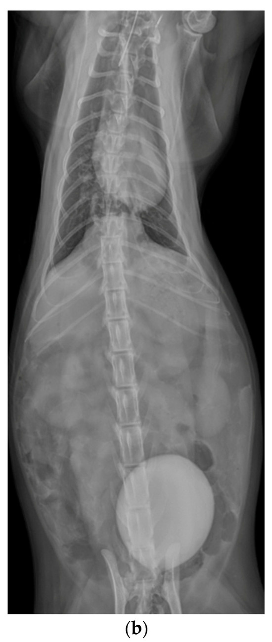 True Diaphragmatic Hernia (Morgagni Hernia) Incidentally Diagnosed with ...