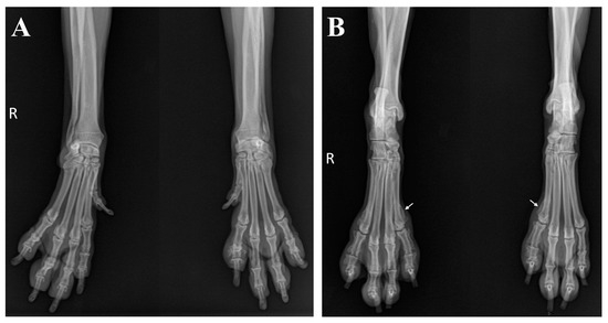 Hypertrophic Osteopathy Concurrent with an Aberrant Right Subclavian ...