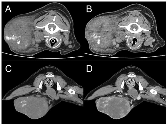 Case Series: Computed Tomography Features of Extraskeletal Osteosarcoma ...