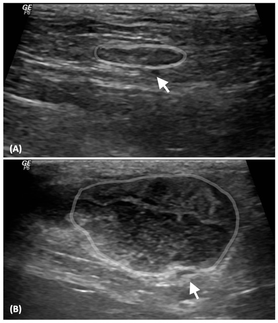 Post-Chemotherapy Canine Lymphomatous Lymph Node Observations on B-Mode ...
