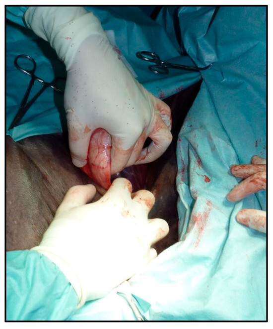 Description and Complications of a New Modified Semi-Closed Castration Technique in Horses