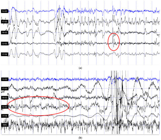 Non-Invasive EEG Recordings in Epileptic Dogs (Canis familiaris)
